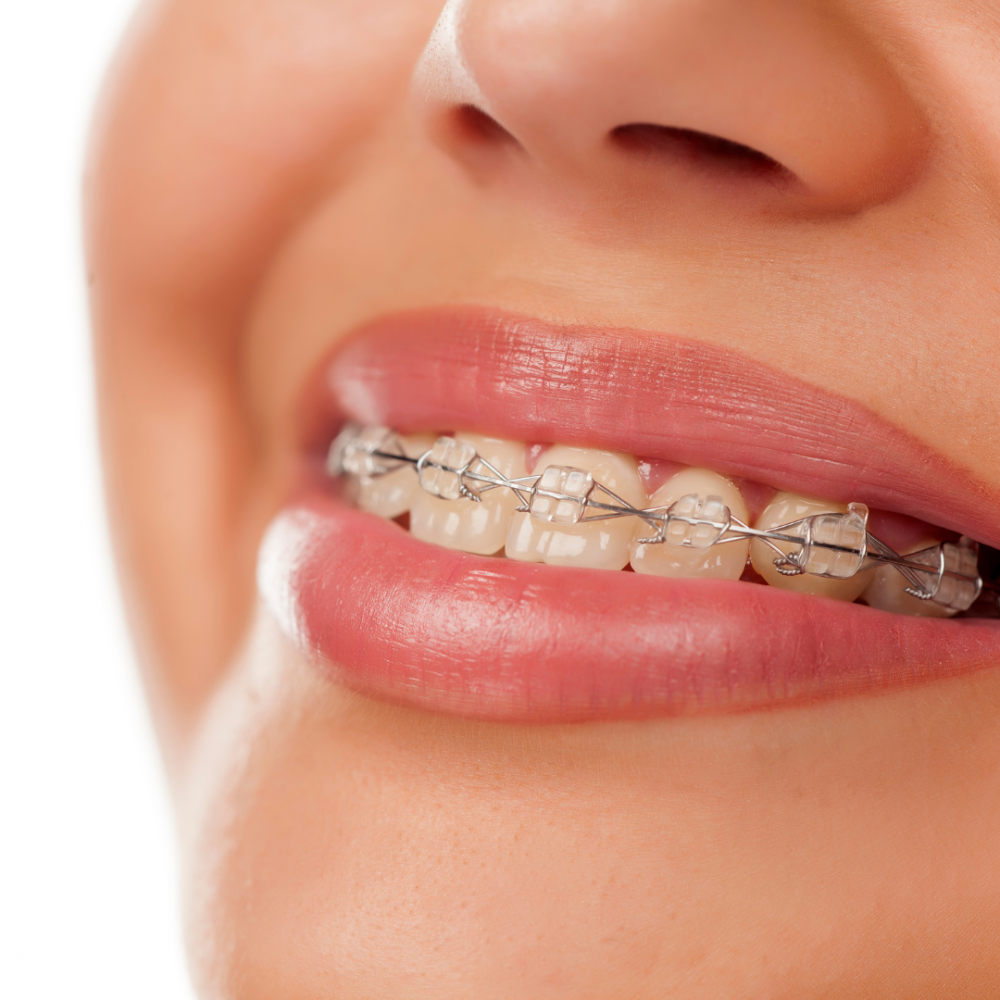 Diferencia entre brackets metálicos y estéticos ⋆ CEMEQ